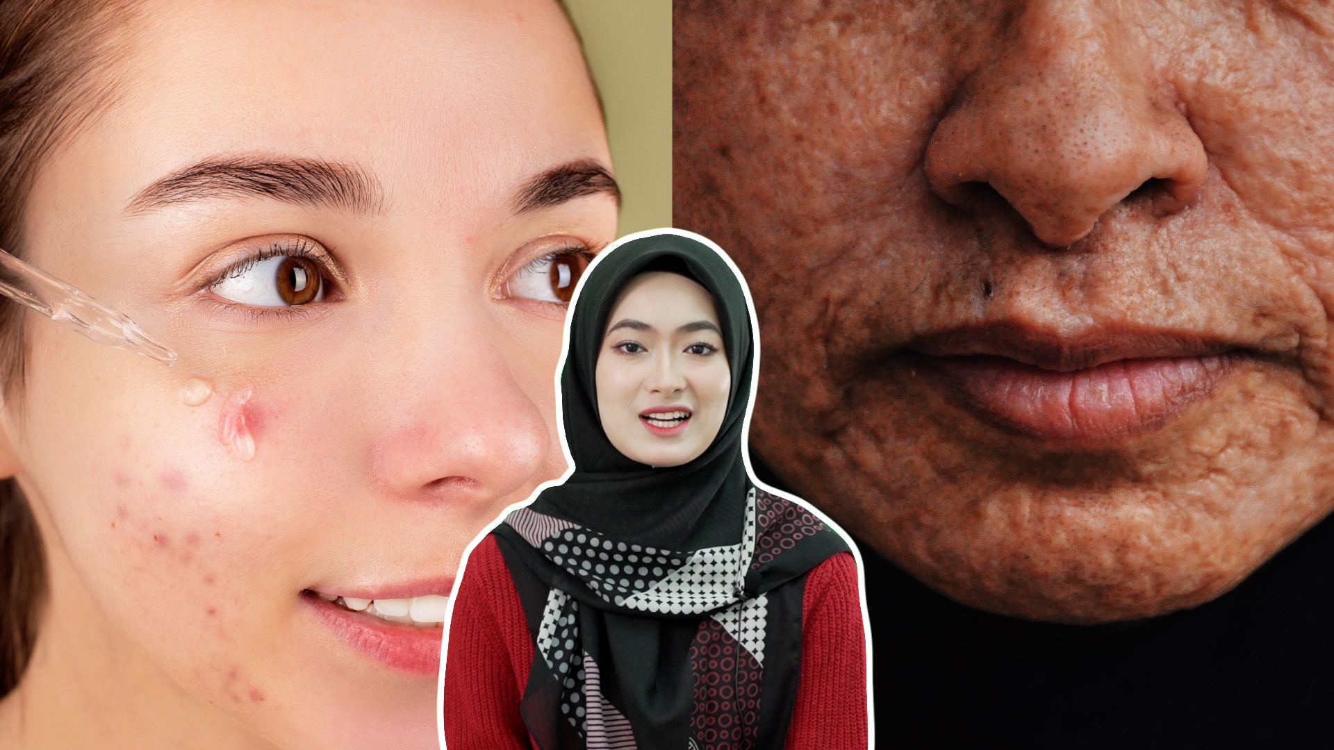 5 Jenis Parut Jerawat – ML Studios