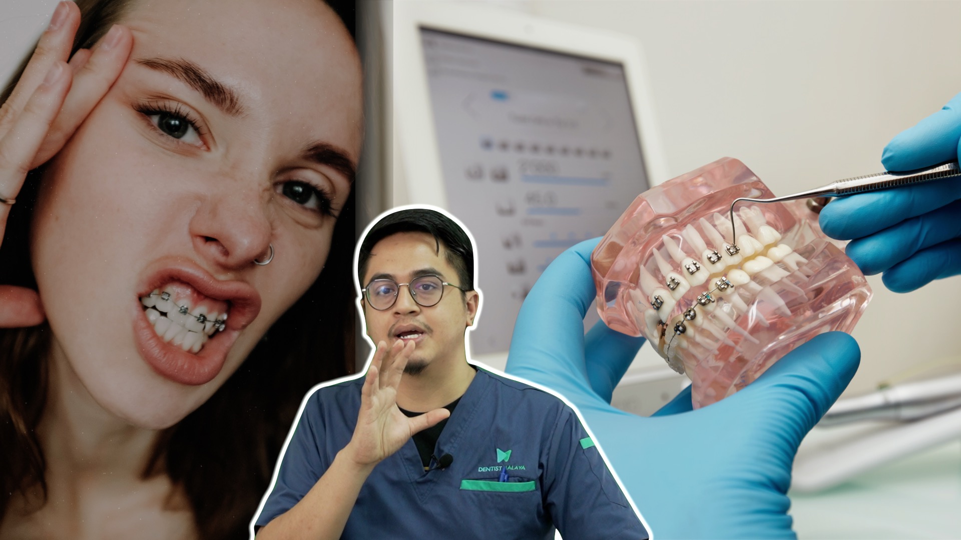 Apa Perlu Buat Lepas Pasang Braces? – ML Studios