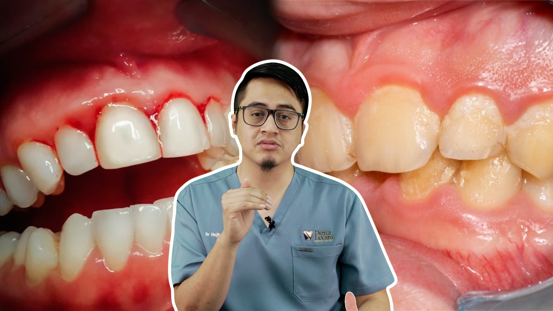 Ini Cara untuk Tahu Gusi Anda Sihat Tak – ML Studios