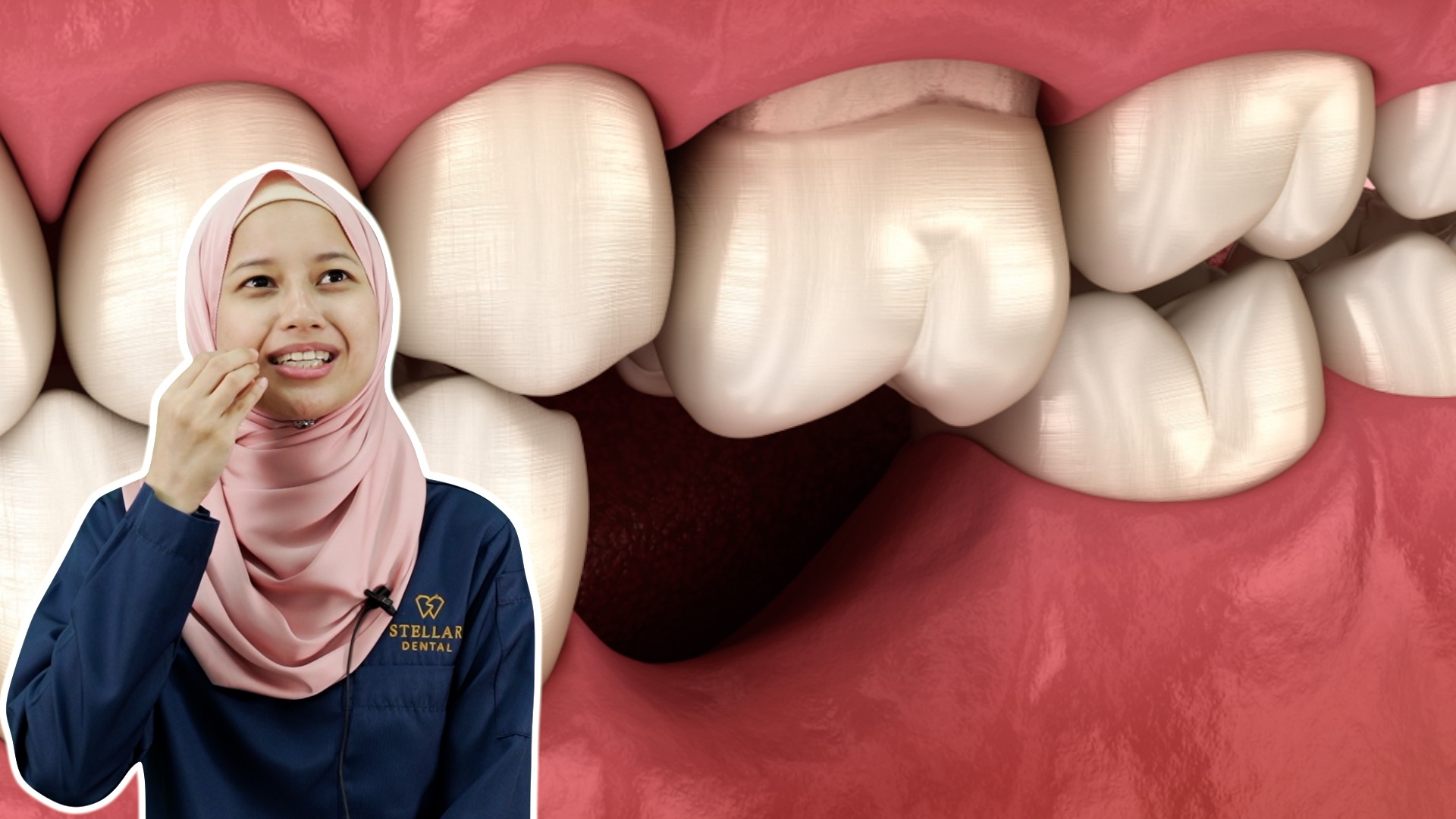 Ini Kesan Jika Anda Tak Ganti Gigi Kekal yang Dicabut – ML Studios